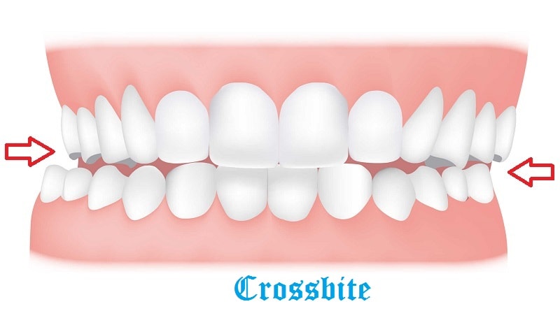 Your Dentist Answers: What is a Crossbite? - Applegate Dental Blog